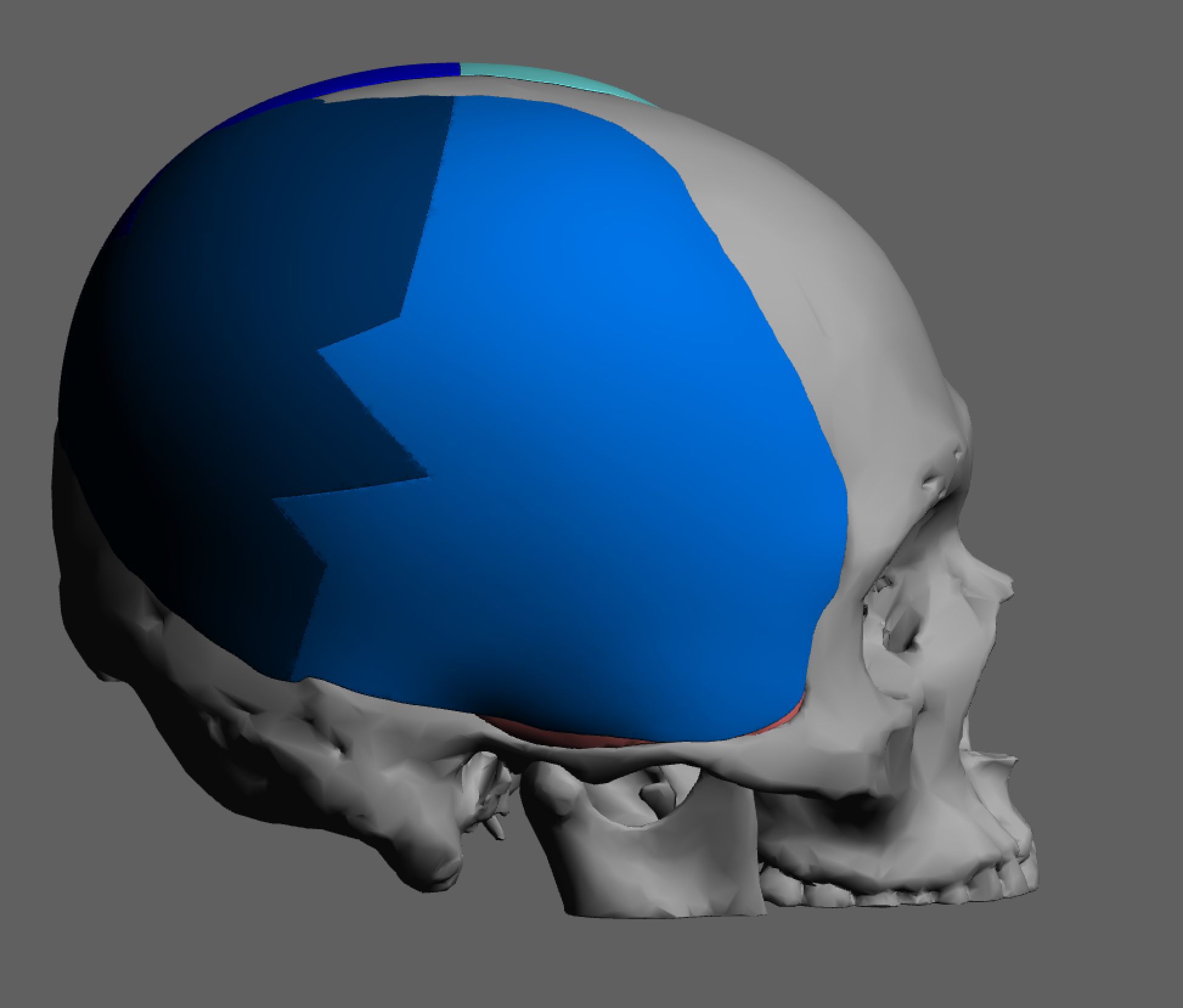 large 4 piece custom head widening implants design side view Dr Barry ...