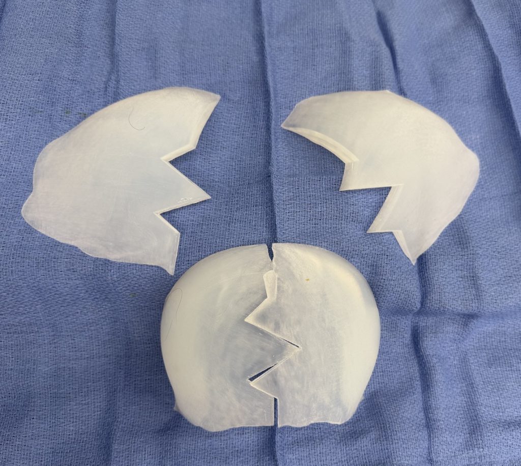 Plastic Surgery Case Study: Large Four-Piece Custom Skull Implant for ...