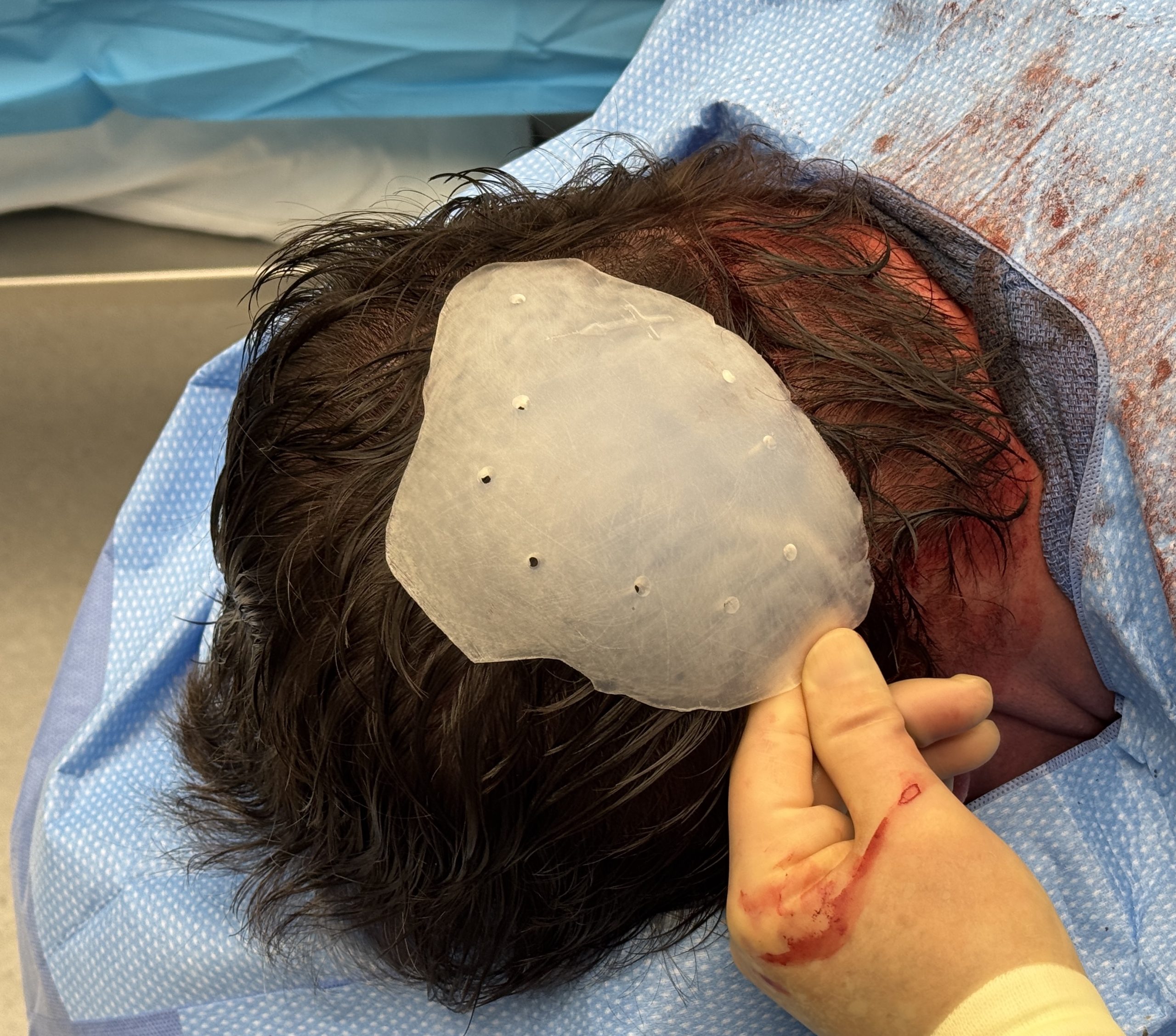 left plagiocephqly custom skull implant placement intraop Dr Barry ...