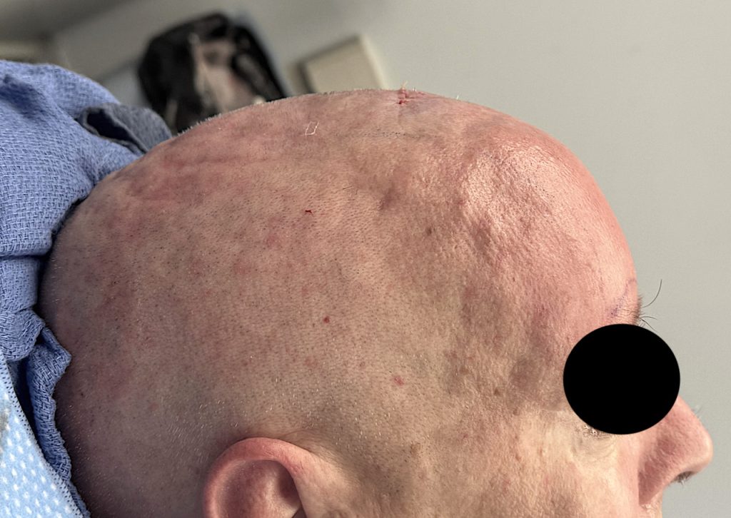 Plastic Surgery Case Study - Custom Skull Implant for Creating a Smooth ...