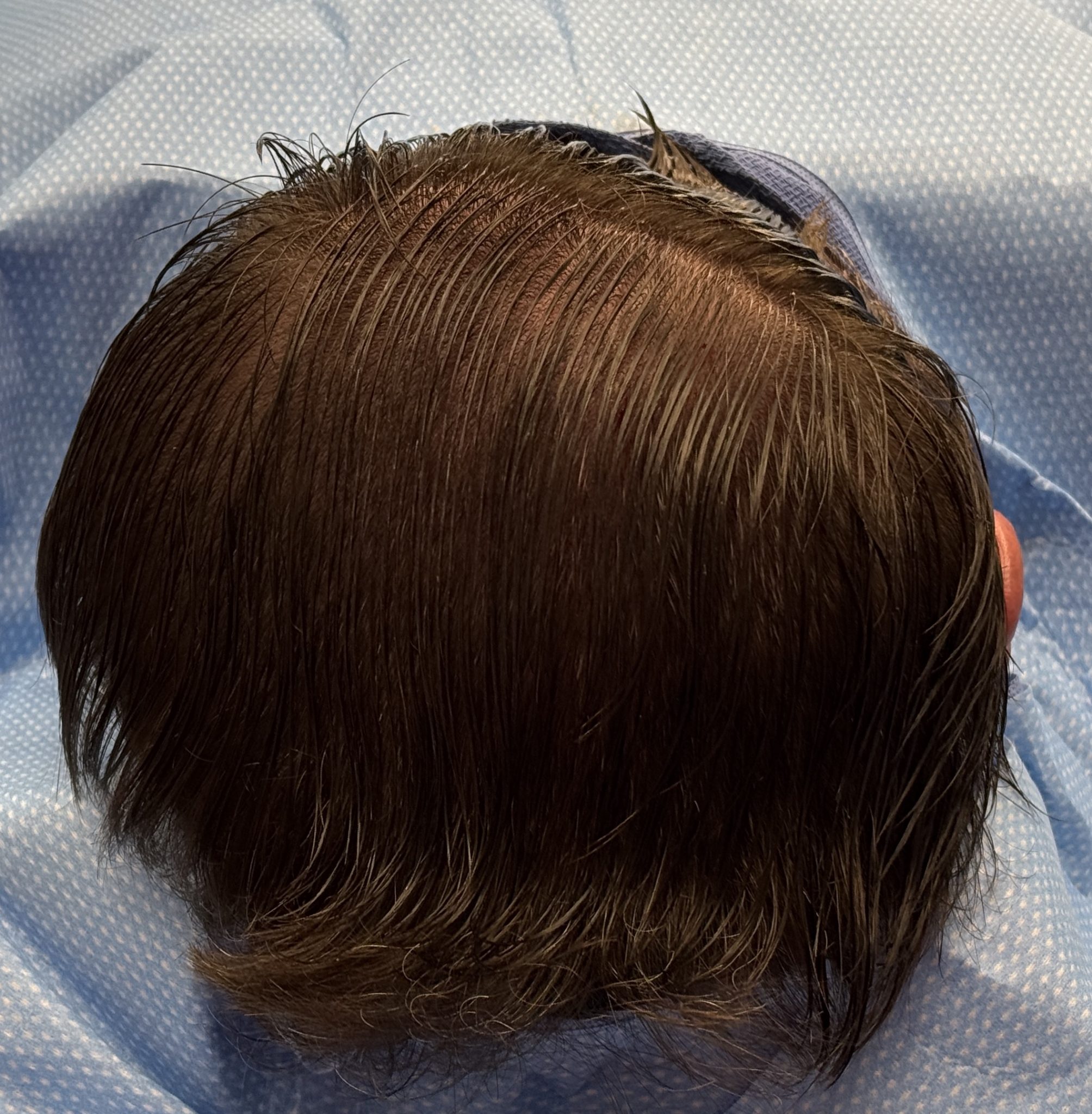 Plastic Surgery Case Study - Plagiocephaly Correction with a Custom ...