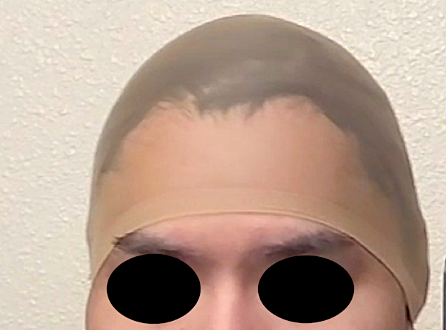 male narrow head shape front 1 Dr Barry Eppley - Explore Plastic Surgery