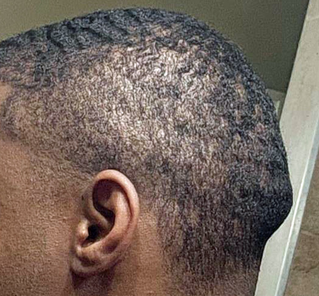 Plastic Surge Case Study - Combined Bony and Soft Tissue Occipital Knob ...