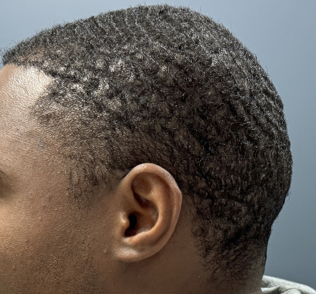 Plastic Surge Case Study - Combined Bony and Soft Tissue Occipital Knob ...