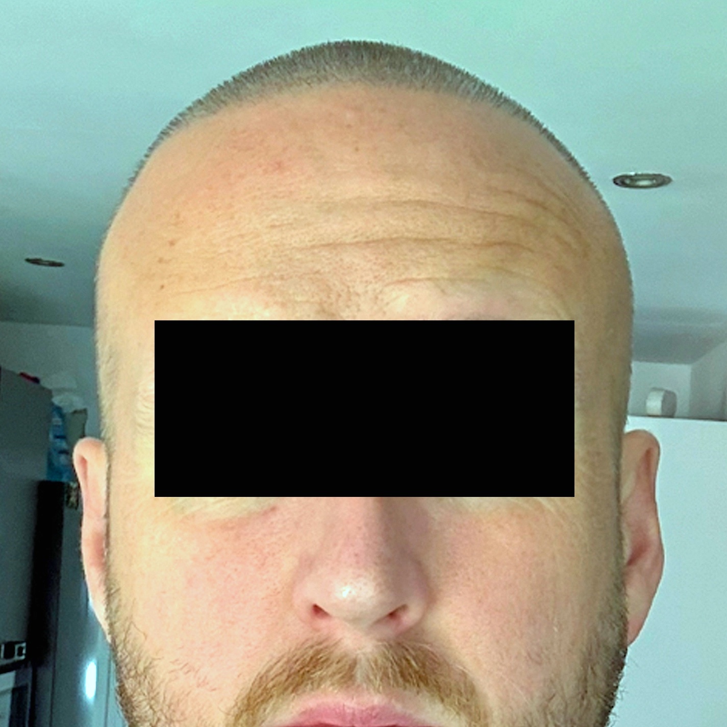 male temporal rediuction and setback otoplasty front 2 Dr Barry Eppley ...