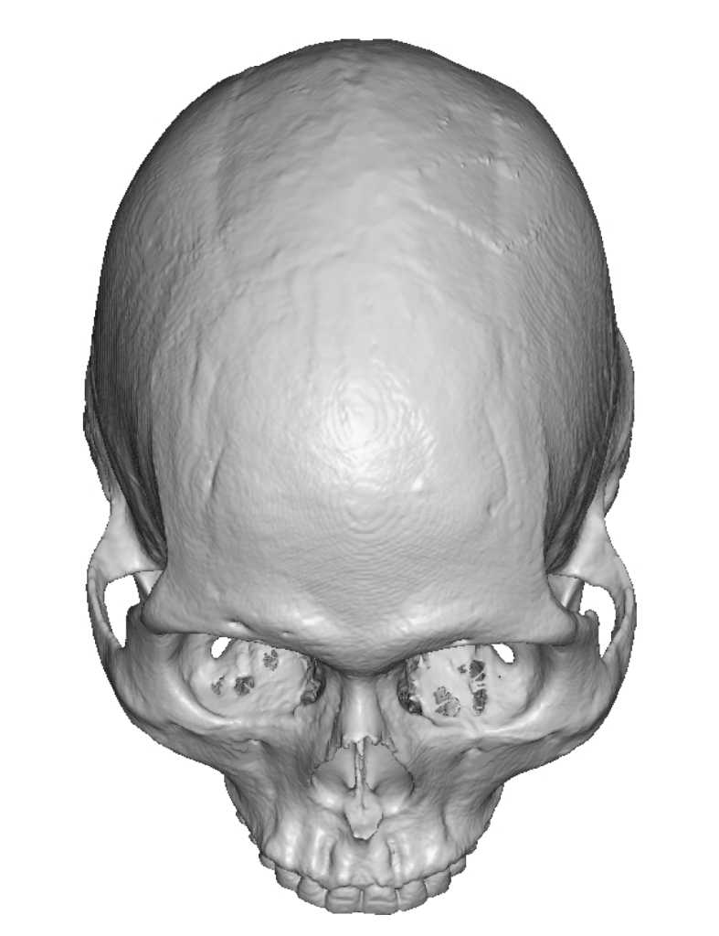 Plastic Surgery Case Study: Large Four-Piece Custom Skull Implant for ...