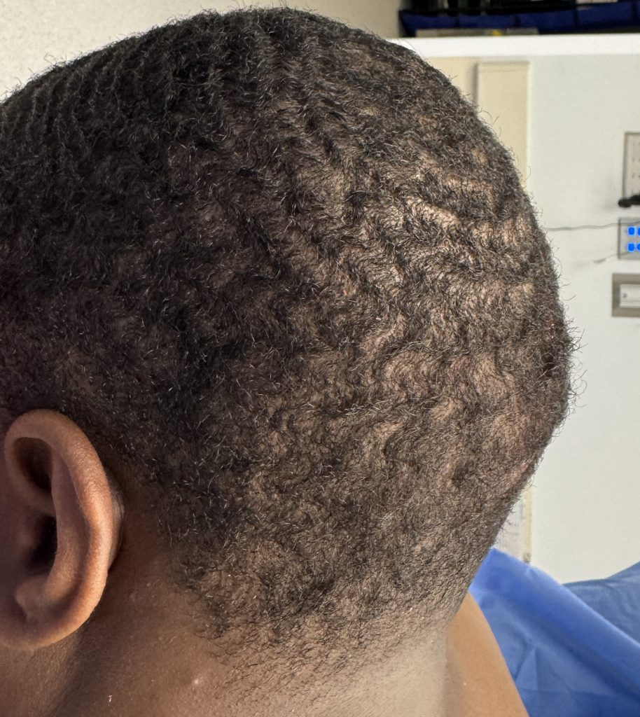 Plastic Surge Case Study - Combined Bony and Soft Tissue Occipital Knob ...