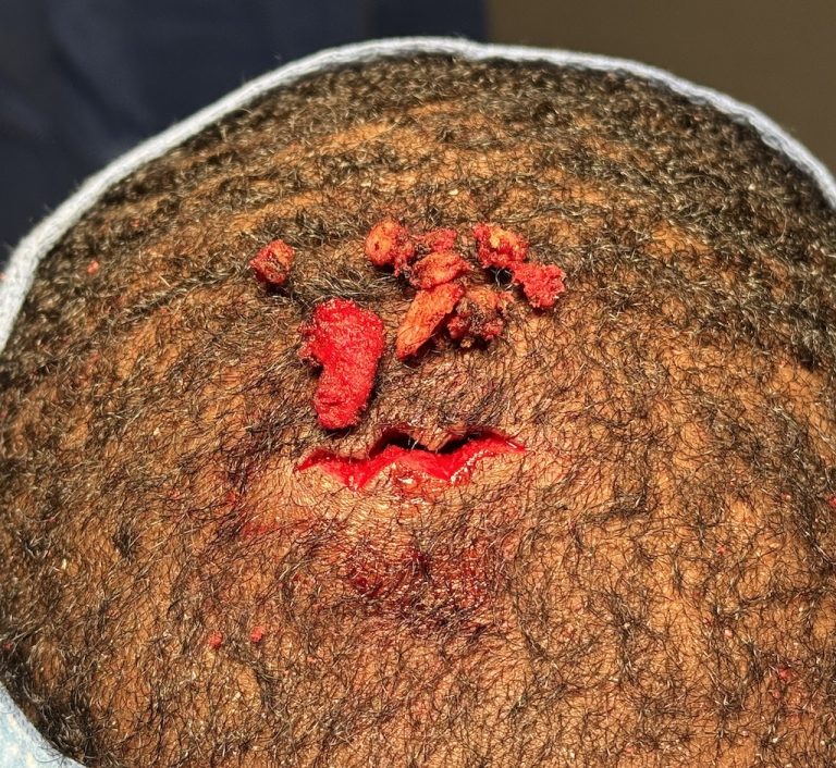 occipital knob soft tissue removal back view Dr Barry Eppley - Explore ...