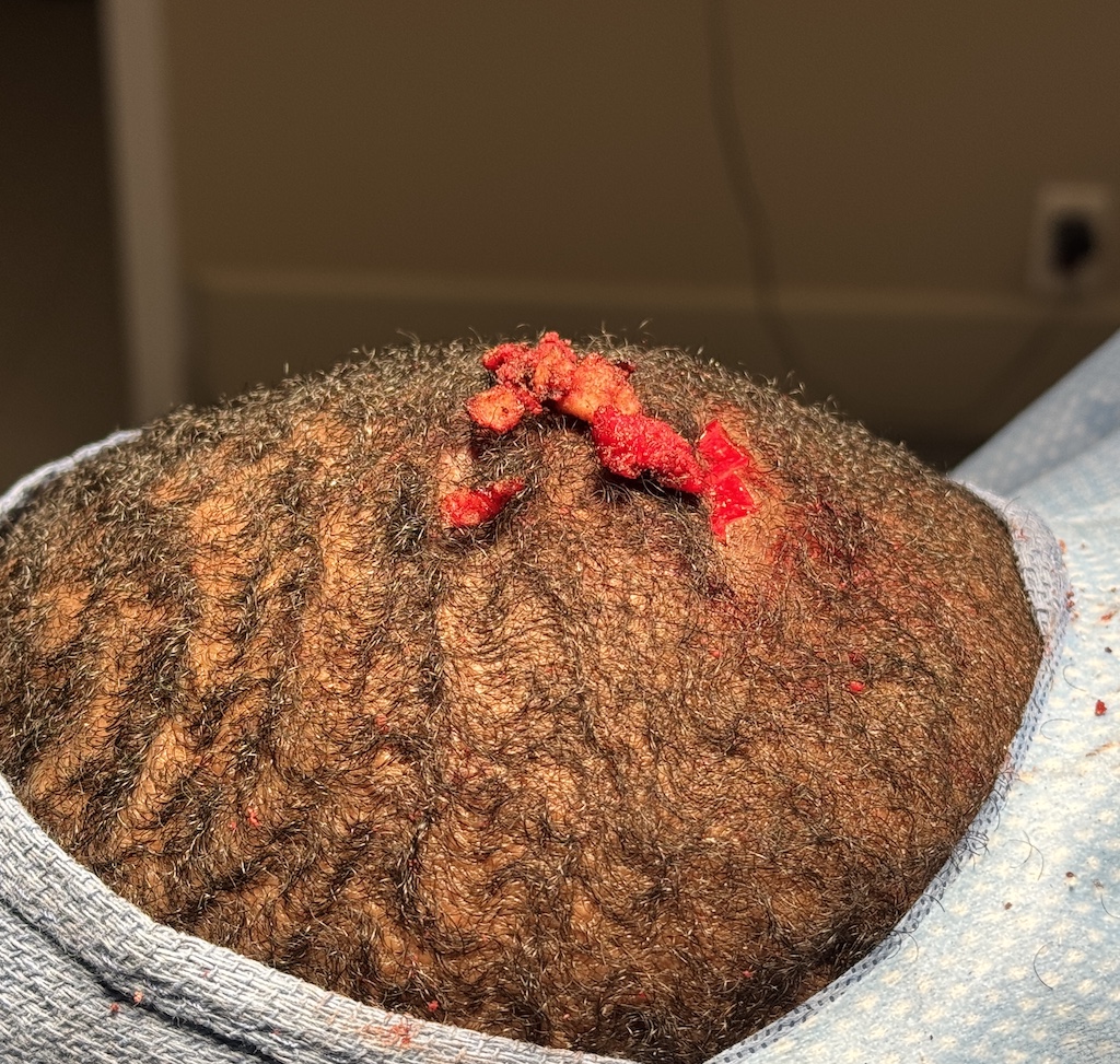 occipital knob soft tissue removal side view Dr Barry Eppley - Explore ...