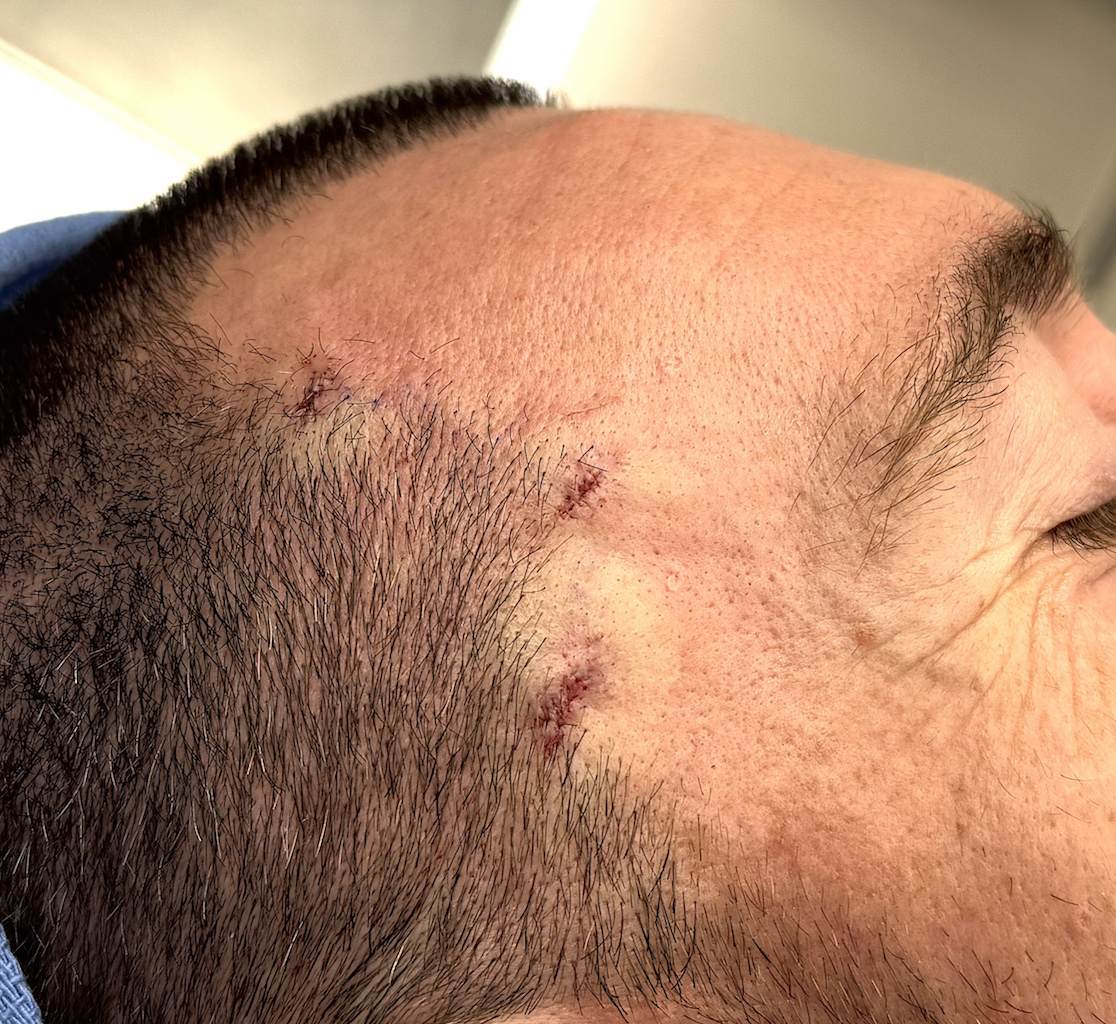 righgt temporal artery ligafions completed Dr Barry Eppley - Explore ...