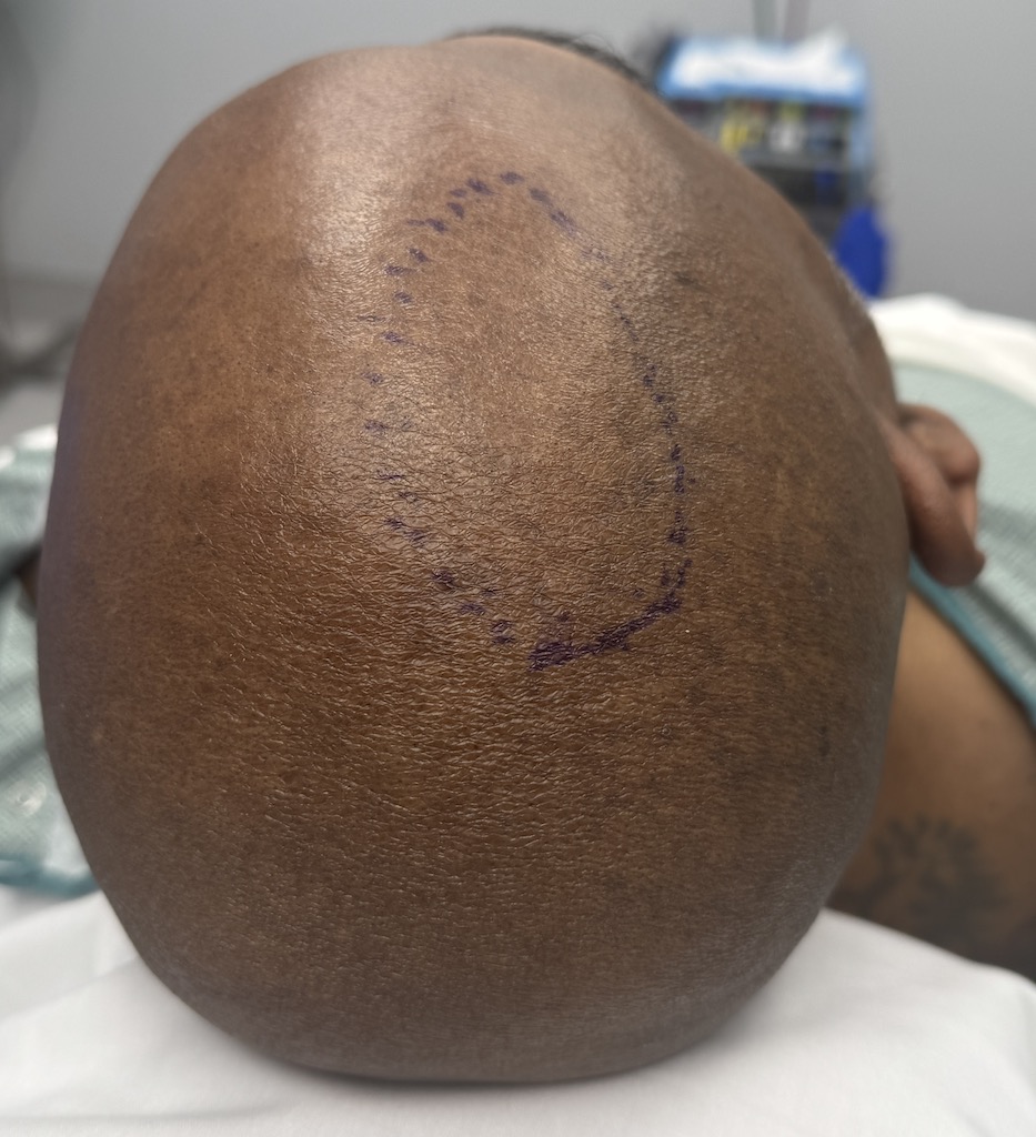 right parasagttal skull defect Dr Barry Eppely - Explore Plastic Surgery