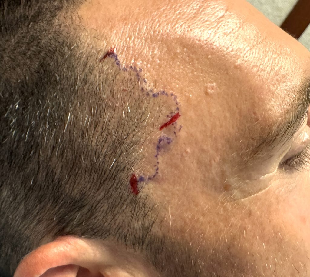 Plastic Surgery Case Study - Loop Extraction Technique for Prominent ...