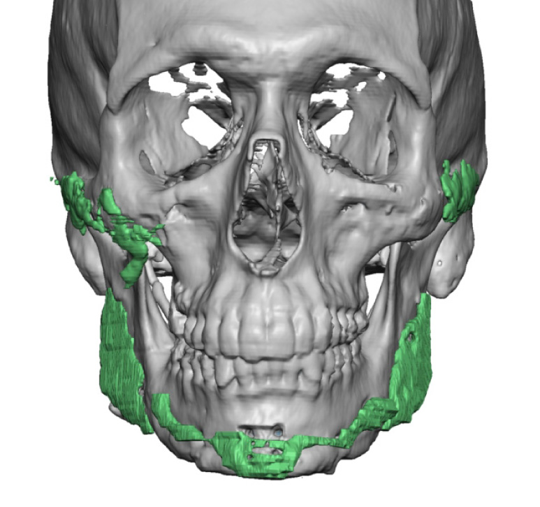 Injectable Fillers and Custom Facial Implant Designs - Explore Plastic ...