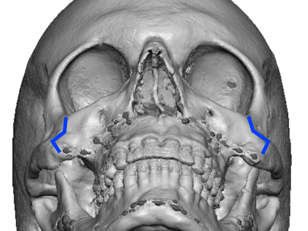 Zygomatic Sandwich Osteotomy (ZSO) Cheek Augmentation Reversal ...
