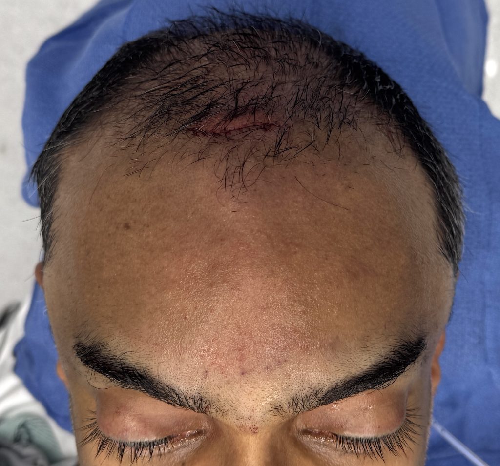 Plastic Surgery Case Study: Aesthetic Head Widening Skull Implants for ...