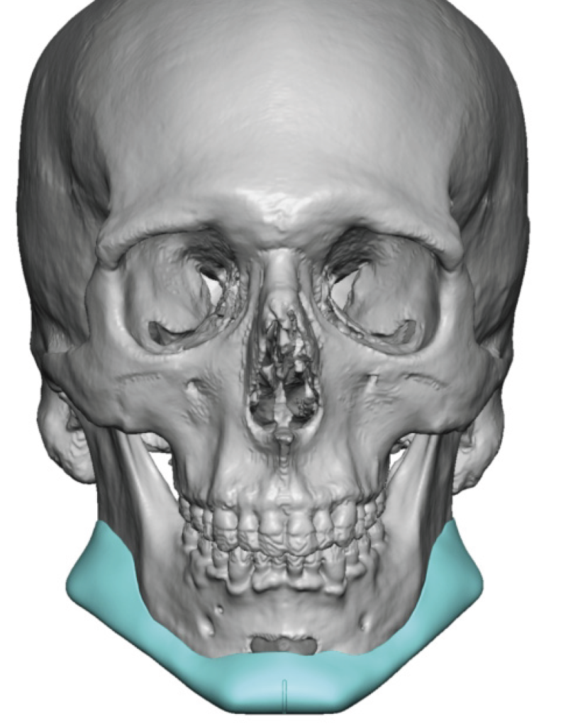 Key Considerations in Custom Jawline Implant Design: Focus on the Jaw ...