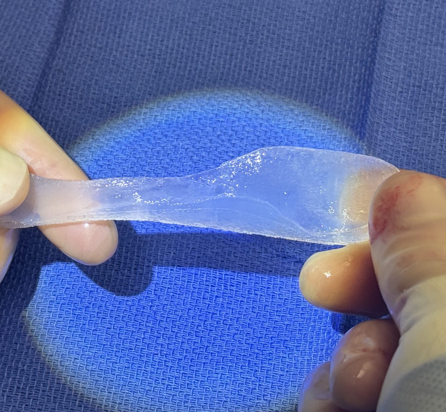 Key Considerations in Custom Jawline Implant Design: Focus on the Jaw ...