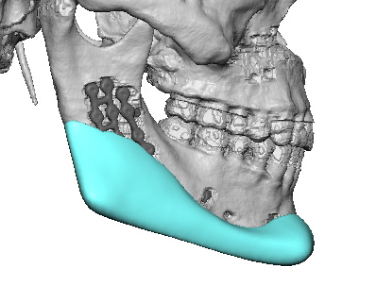 Plastic Surgery Case Study : Secondary Jawline Augmentation After Chin ...