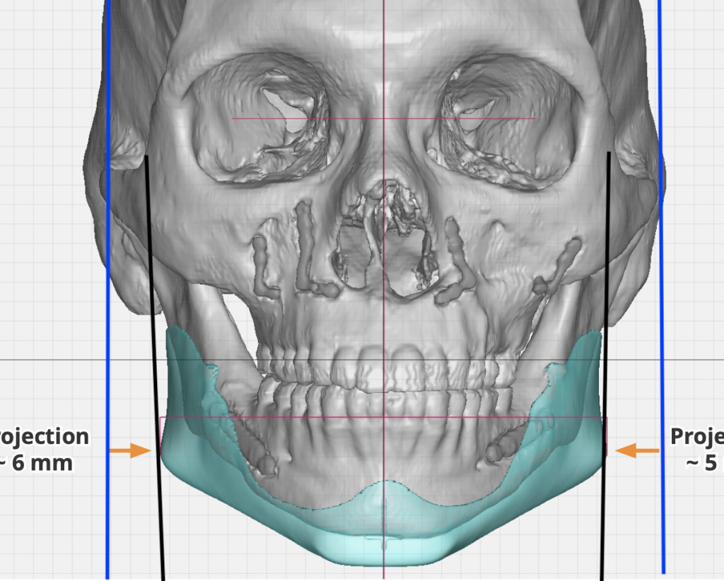The Aesthetic Importance of the Jaw Angle: Measurement, Design and ...