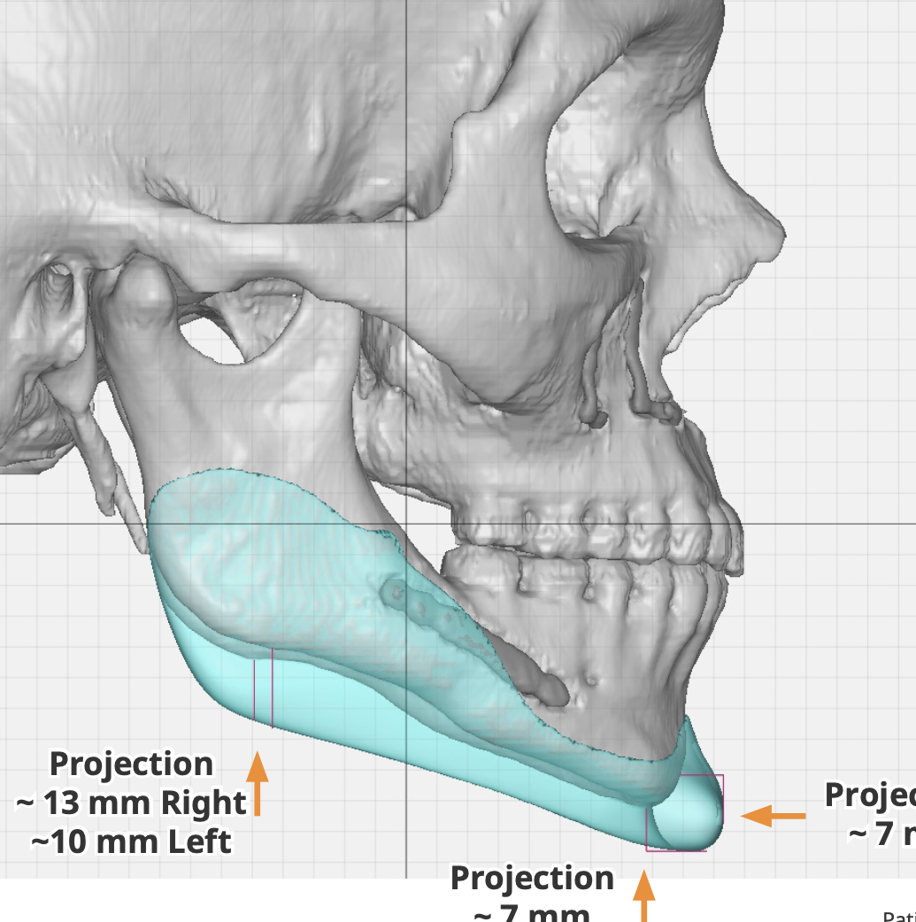 The Aesthetic Importance of the Jaw Angle: Measurement, Design and ...