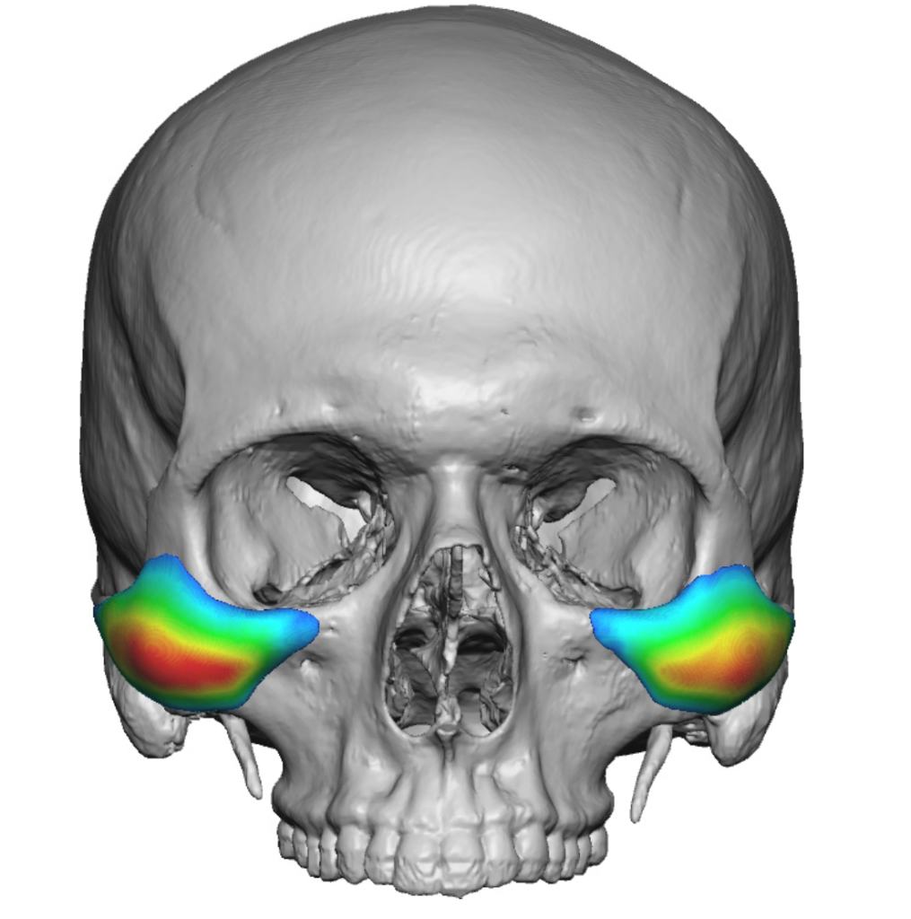 Cheek Augmentation in Men: Custom Implants for a High Cheekbone Look ...