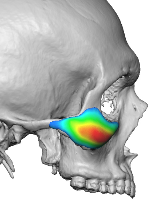 high cheek implant thicknesses side view Dr Barry Eppley - Explore ...