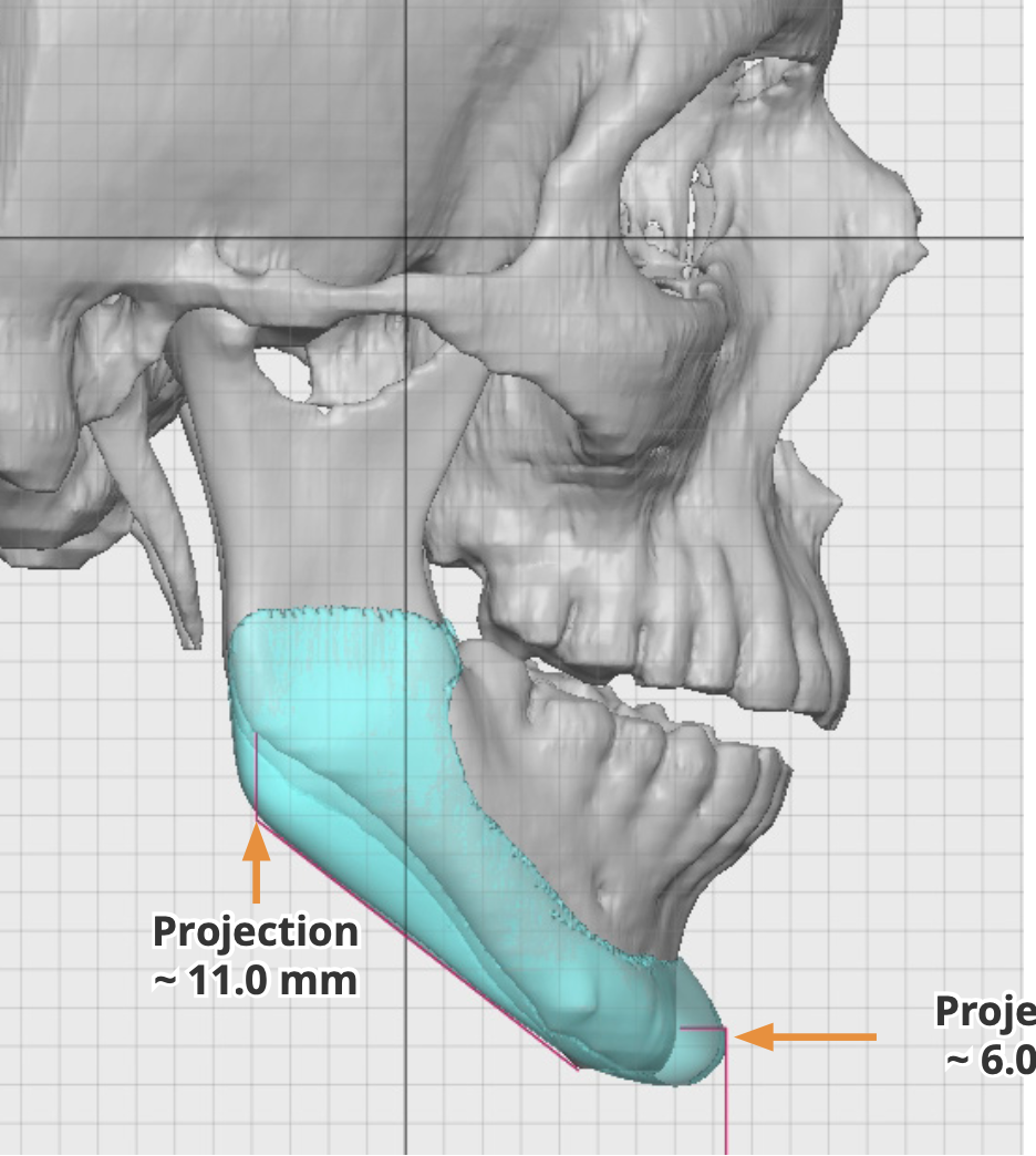 The Aesthetic Importance of the Jaw Angle: Measurement, Design and ...