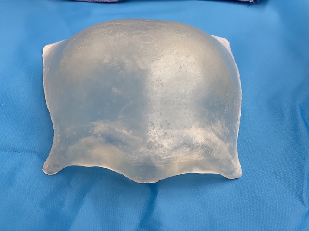 Combining Forehead Augmentation and Frontal Hairline Advancement: A Case Study - Explore Plastic ...