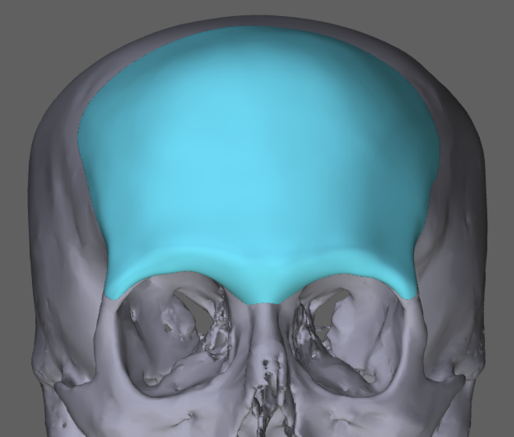 Combining Forehead Augmentation and Frontal Hairline Advancement: A ...
