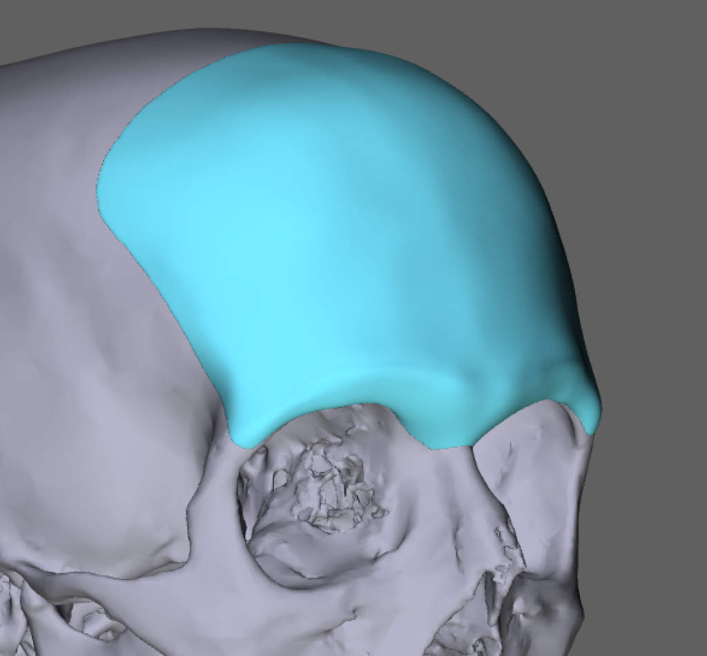 Combining Forehead Augmentation and Frontal Hairline Advancement: A Case Study - Explore Plastic ...