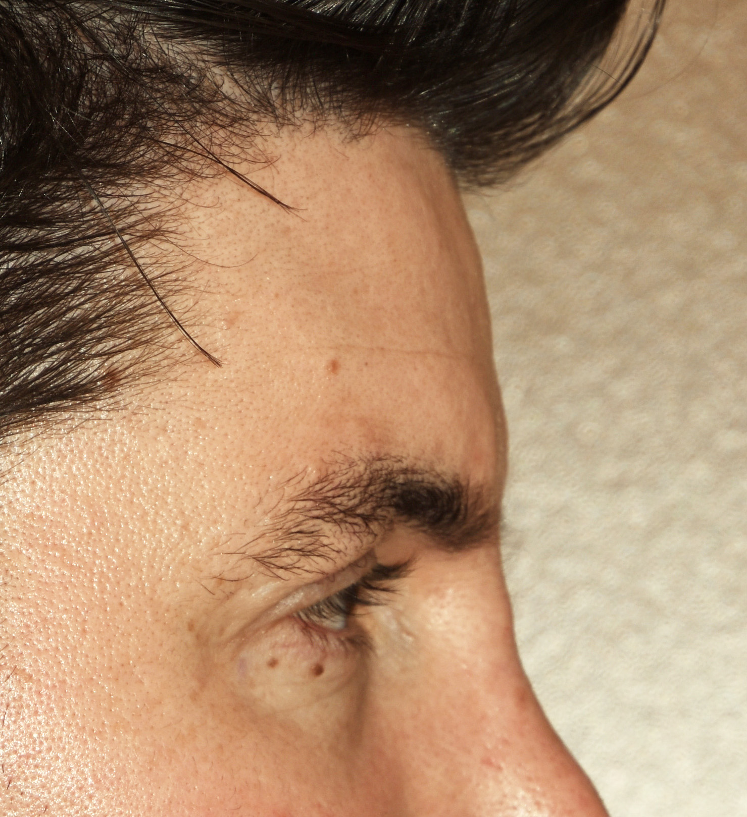 Custom Forehead Augmentation in Men: A Case Study - Explore Plastic Surgery