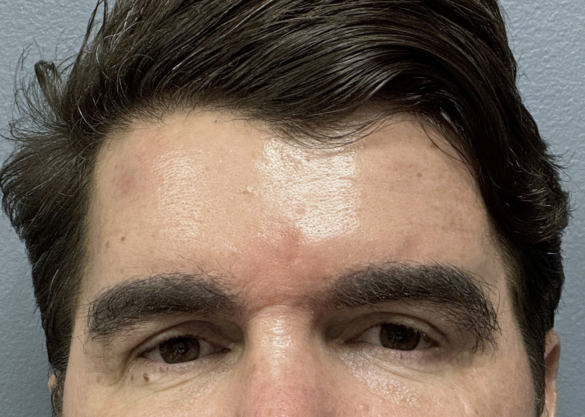 Custom Forehead Augmentation in Men: A Case Study - Explore Plastic Surgery