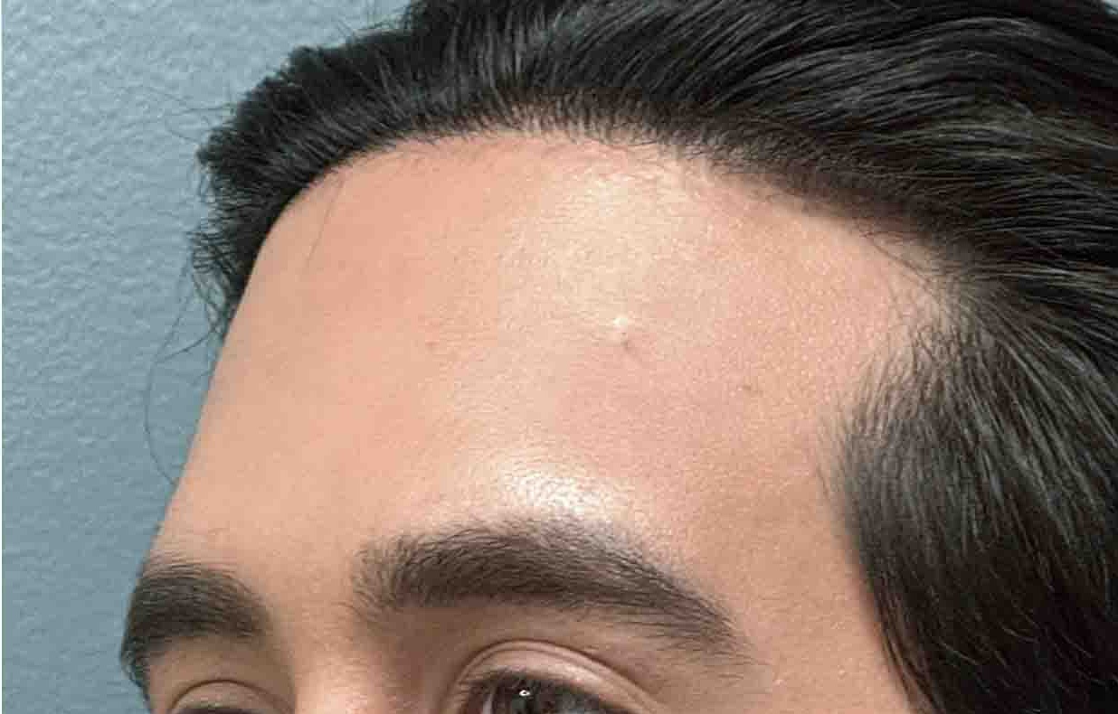 male forehead reshaping oblique 2 Dr Barry Eppley - Explore Plastic Surgery