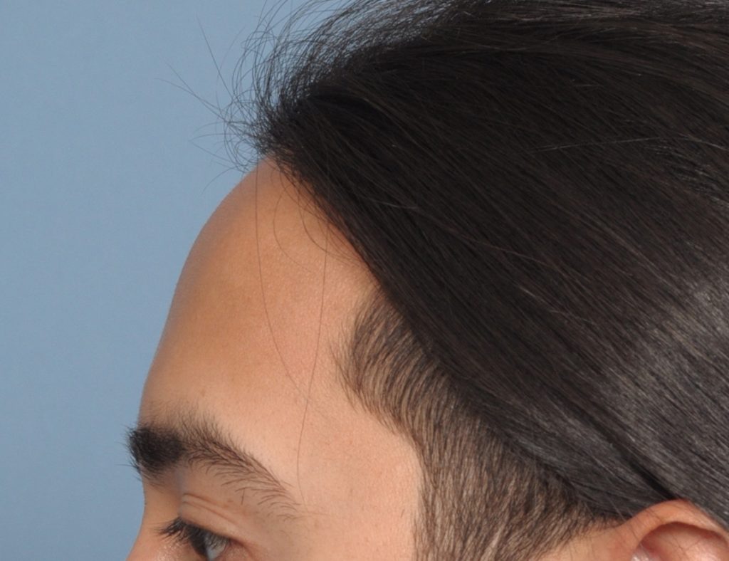 Combining Forehead Augmentation and Frontal Hairline Advancement: A Case Study - Explore Plastic ...