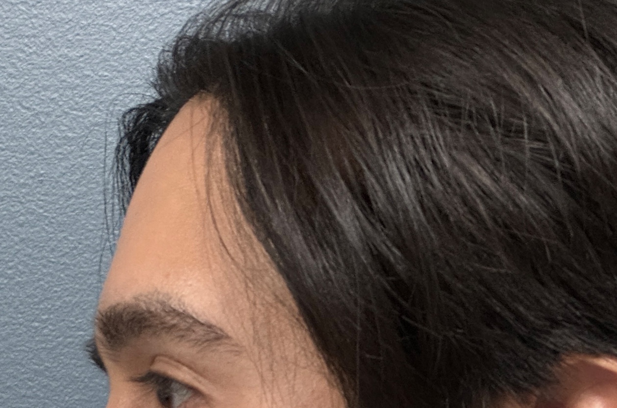 Combining Forehead Augmentation and Frontal Hairline Advancement: A Case Study - Explore Plastic ...