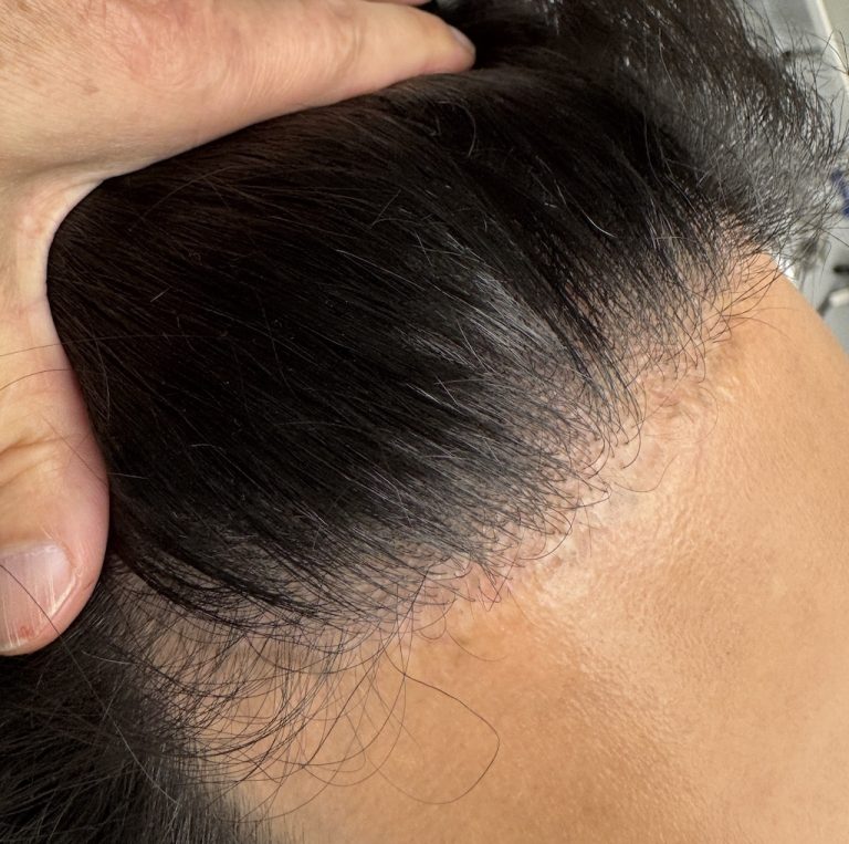 Combining Forehead Augmentation and Frontal Hairline Advancement: A ...