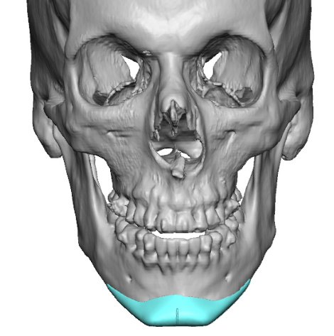 male square chin implamnt desoign front view Dr Barry Eppley - Explore ...