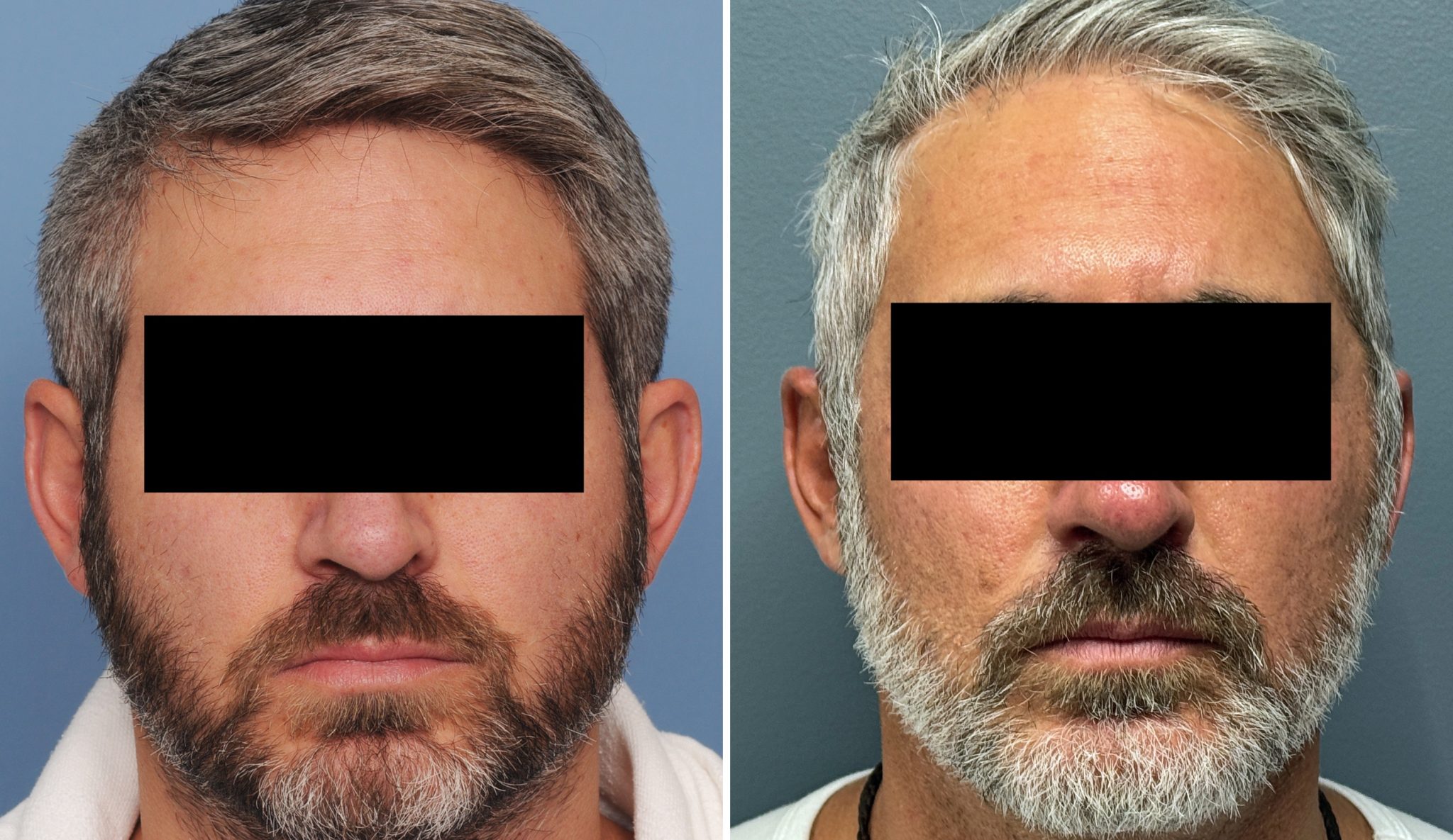 Understanding Temporal Reduction Surgery: Anatomy, Technique, and a ...