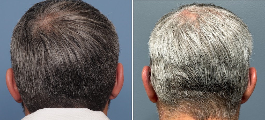 Understanding Temporal Reduction Surgery: Anatomy, Technique, and a ...