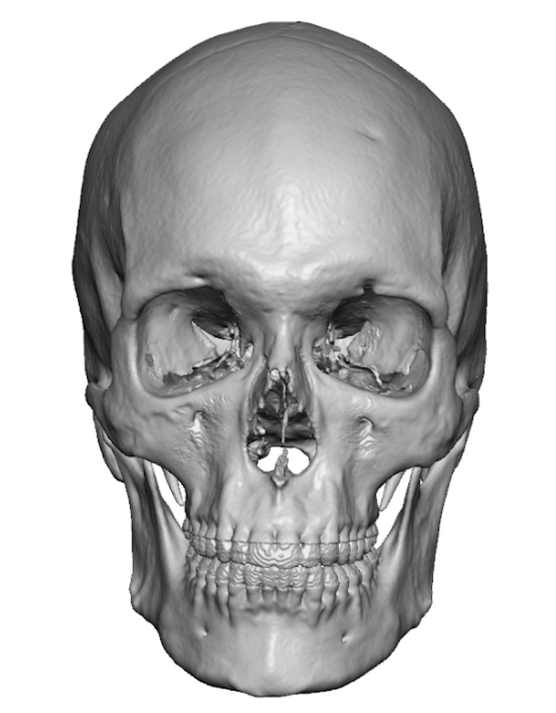 Plastic Surgery Case Study: Aesthetic Head Widening Skull Implants for ...