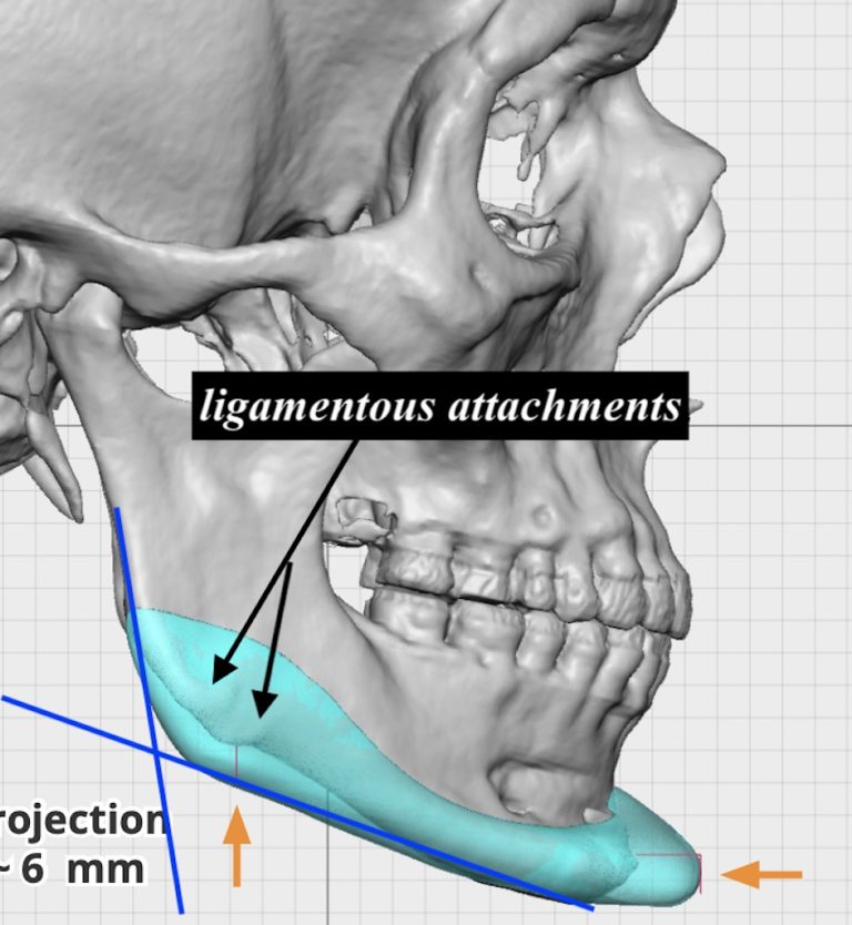 The Aesthetic Importance of the Jaw Angle: Measurement, Design and ...