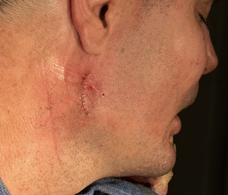 right transcutaneous custo,m jawline implant incision closure Dr Barry ...