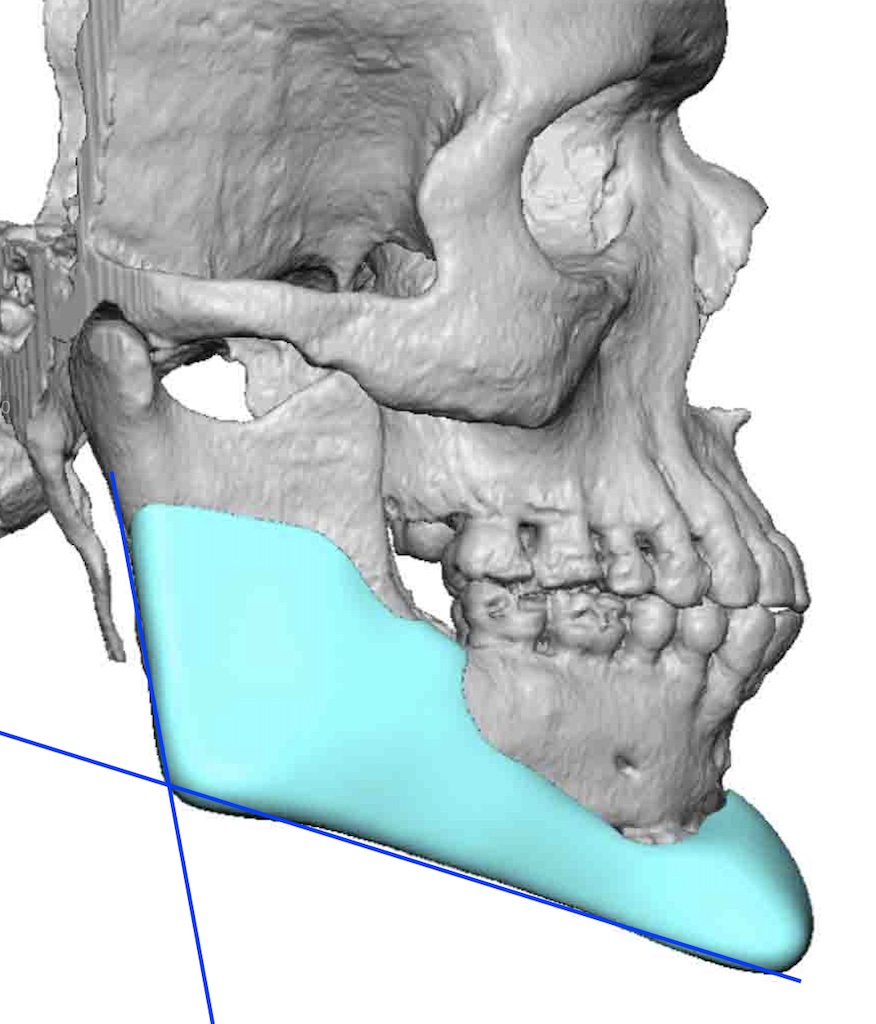 The Aesthetic Importance of the Jaw Angle: Measurement, Design and ...