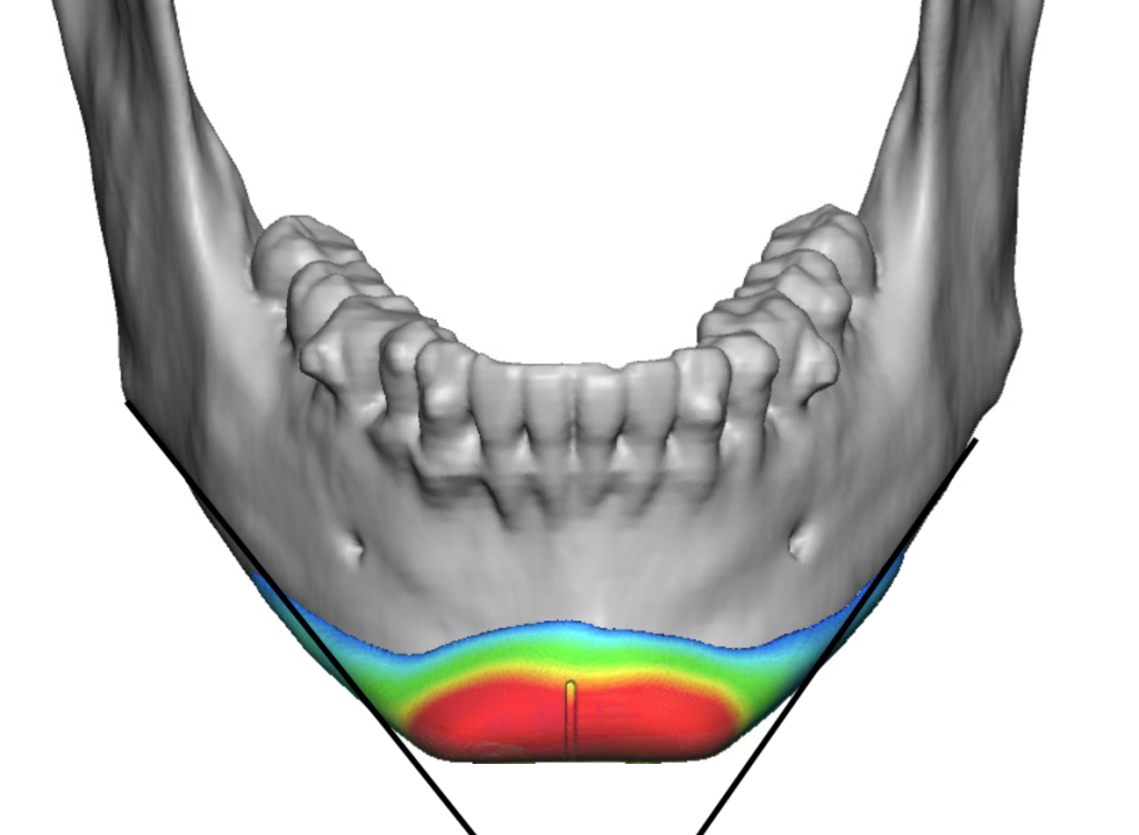 Custom Chin Implant Design: Achieving a Precise and Square Jawline ...