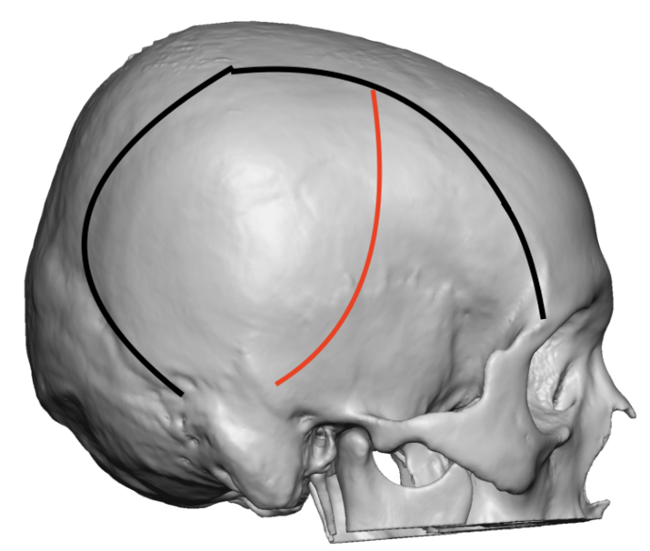 Understanding Temporal Reduction Surgery: Anatomy, Technique, and a ...
