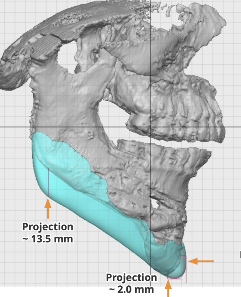 The Aesthetic Importance of the Jaw Angle: Measurement, Design and ...