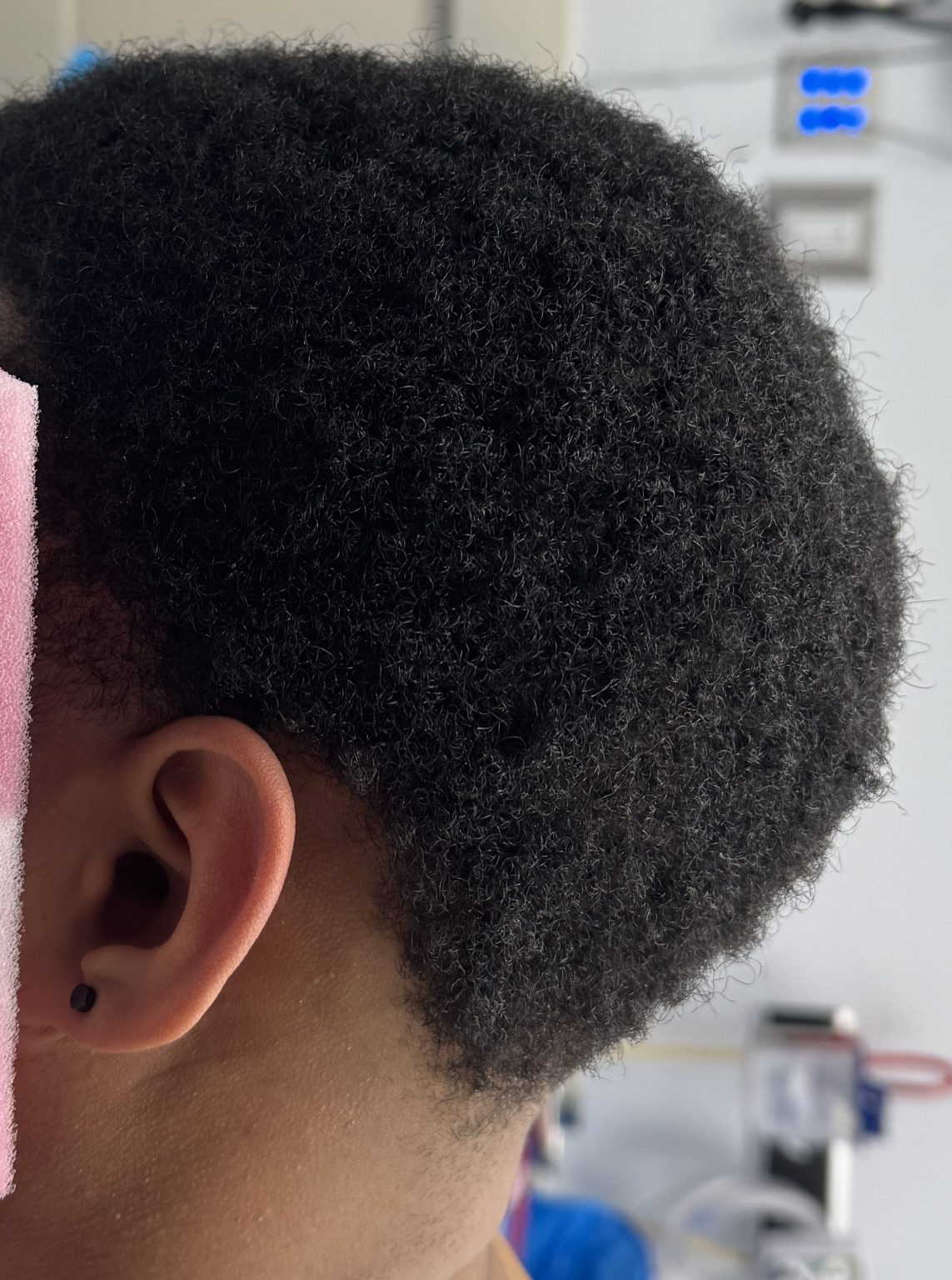 Plastic Surgery Case Study: Occipital Bone Reduction Surgery for ...