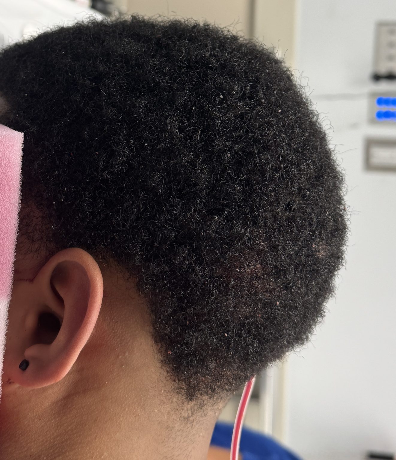 Plastic Surgery Case Study: Occipital Bone Reduction Surgery for ...