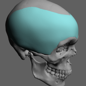 skull reshaping Archives - Explore Plastic Surgery