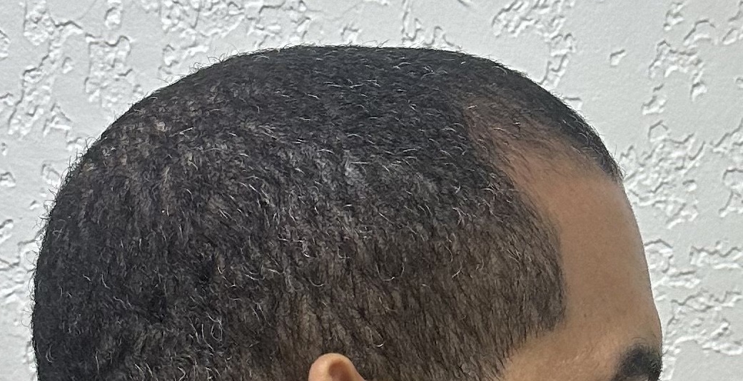 The Anterior Sagittal Crest Reduction in Humans: Case Study - Explore ...